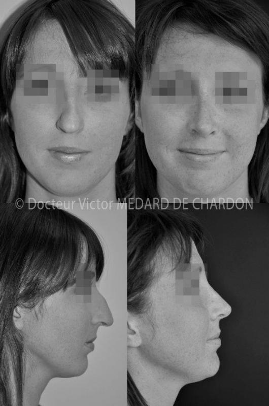 Фото Пластическая хирургия лица | Dr Médard de Chardon
